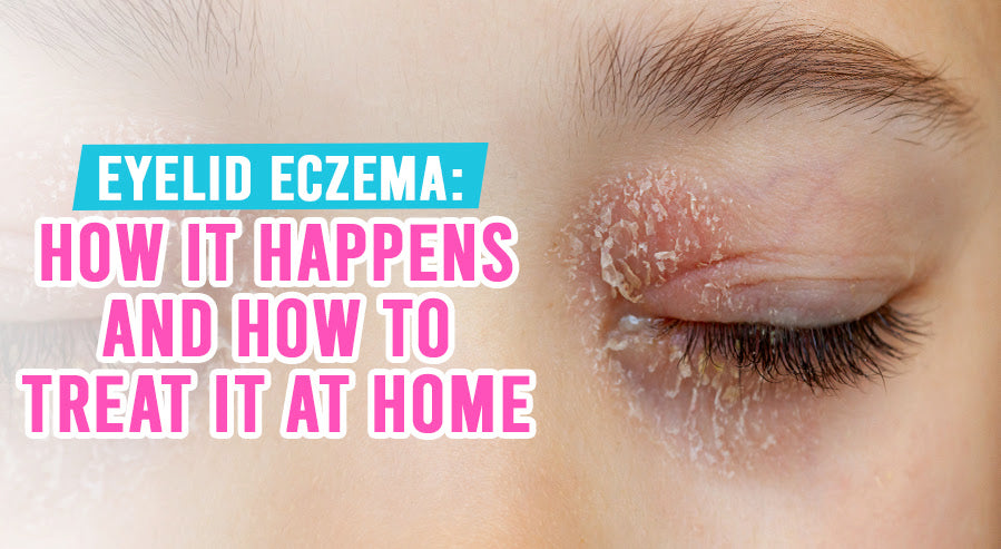 Eyelid Eczema: How It Happens and How to Treat It at Home