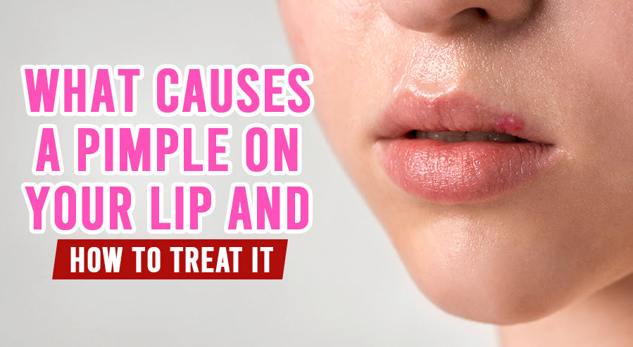 What Causes a Pimple on Your Lip and How to Treat It